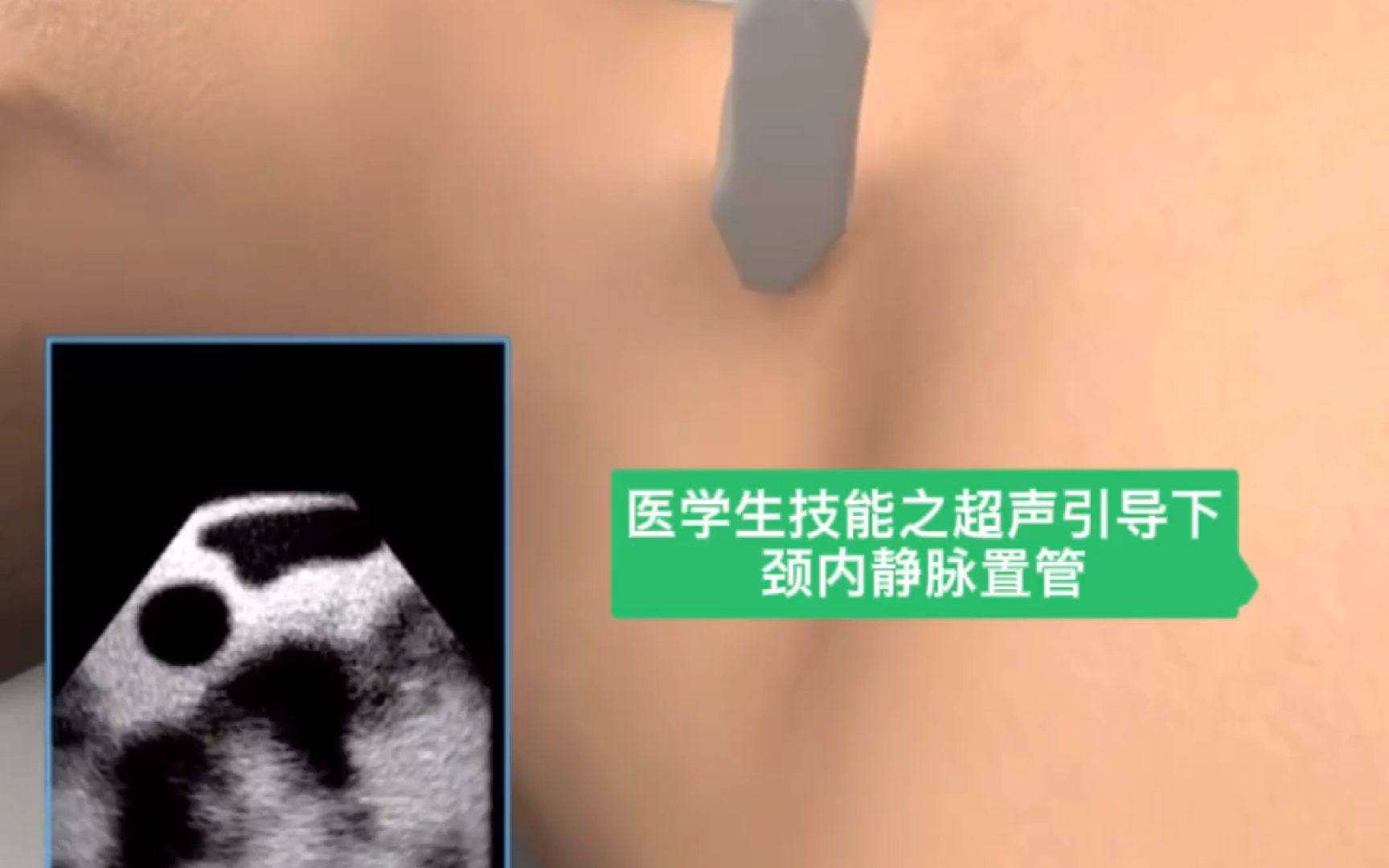 适合医学生反复观看并熟记每个步骤的技能之颈内静脉穿刺置管