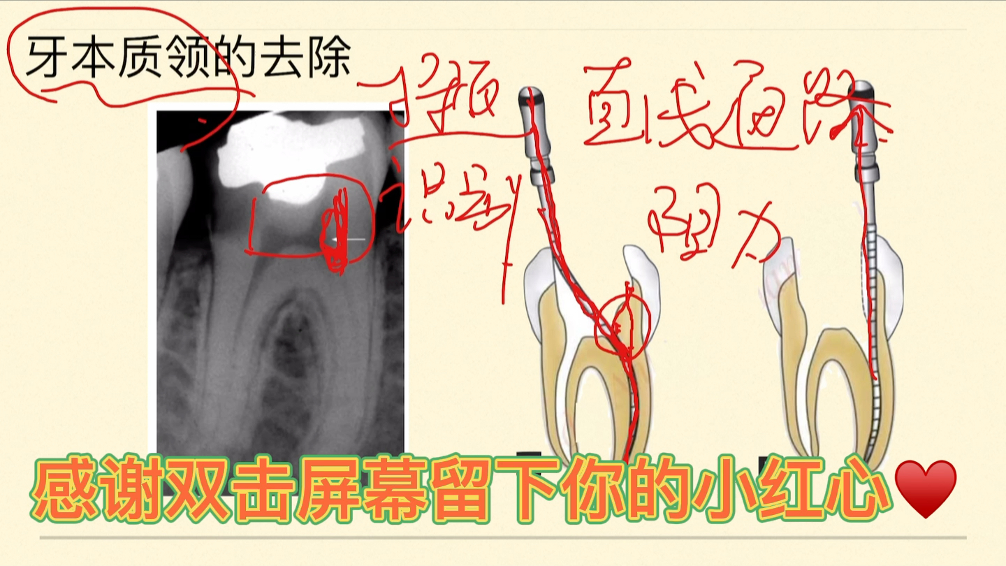 根管治疗中,牙本质领的去除与否直接影响根管口的探查和疏通,根管...