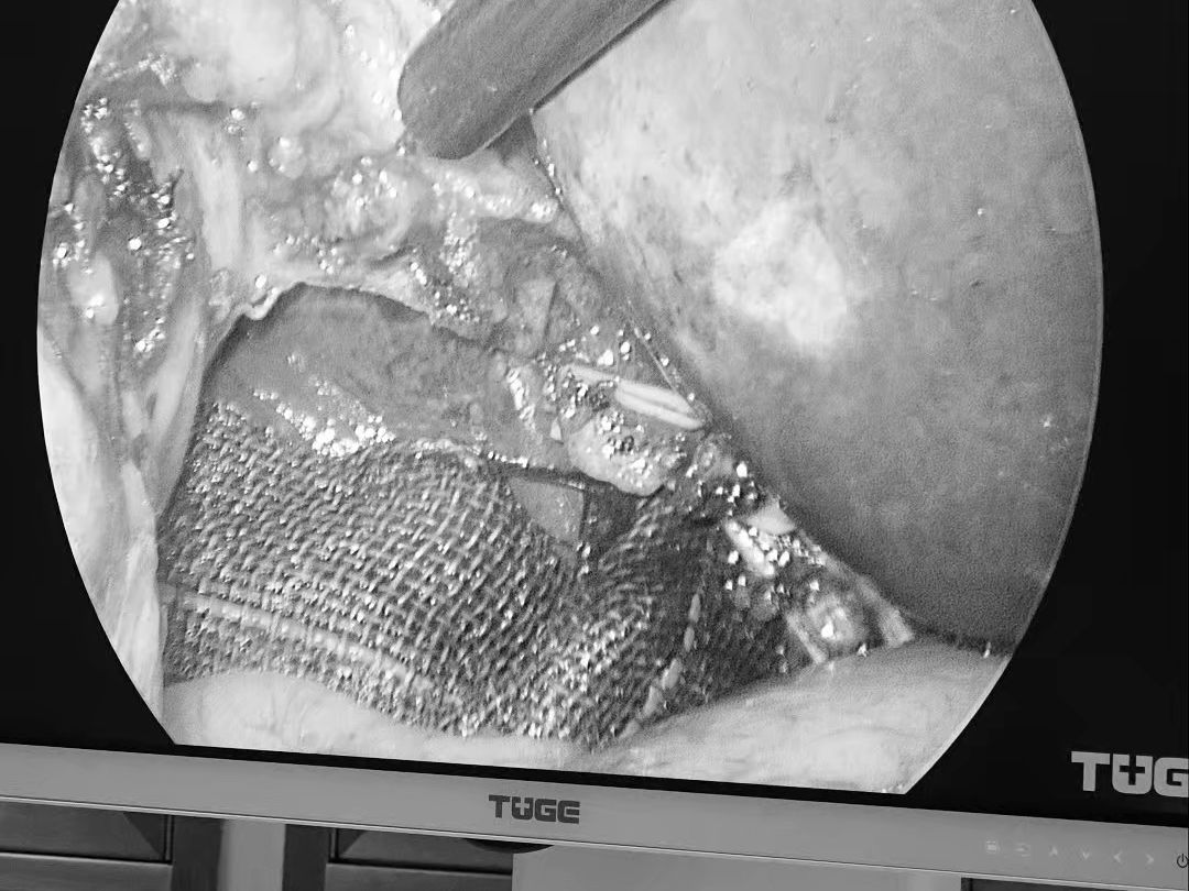 四川胆结石专科医院手术视频:胆结石微创胆囊切除术全过程