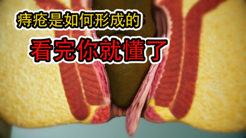 痔疮是如何化形成的,十人九痔是真的吗