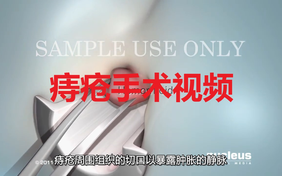 【医学科普视频】:痔疮手术视频