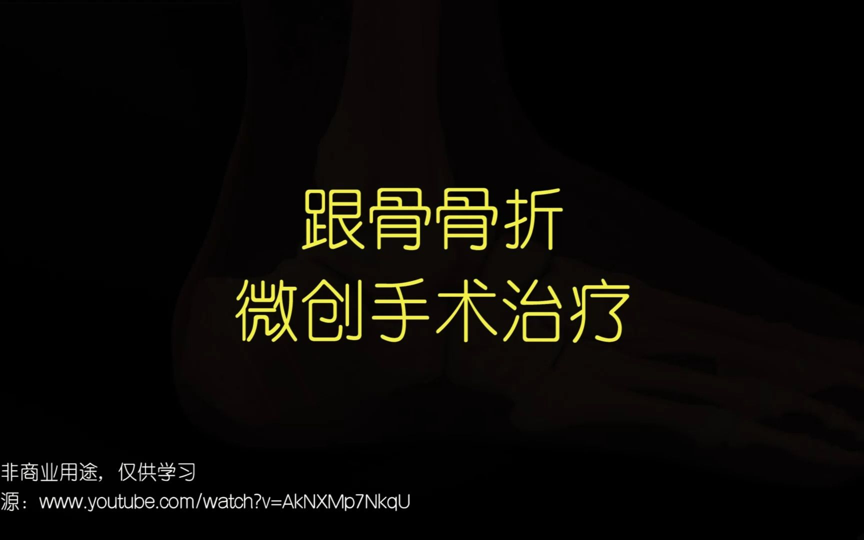 跟骨骨折微创手术治疗3D模拟
