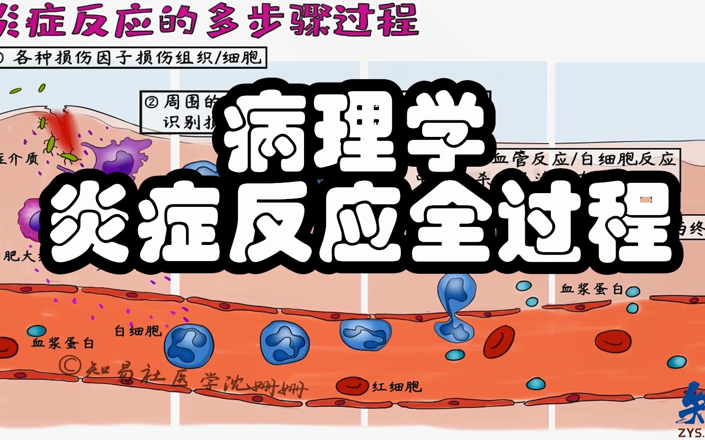 医学带背5分钟 病理学 炎症反应的过程总结