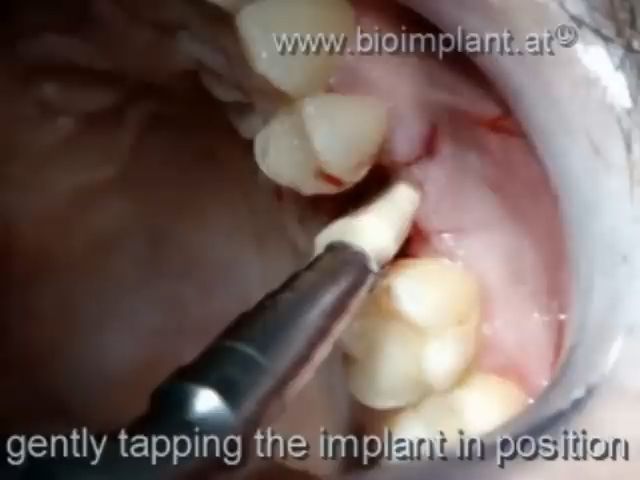 奥地利的免钻牙槽骨种植牙
