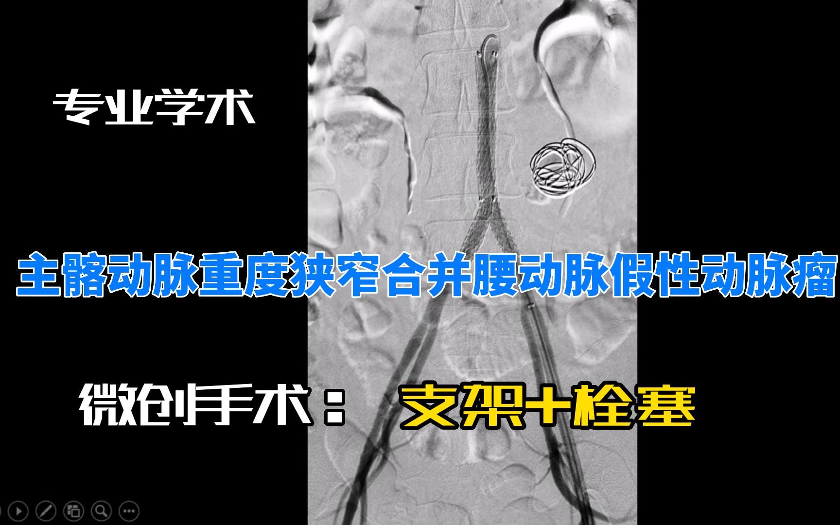 [学术]主髂动脉重度狭窄合并左腰动脉瘤的微创治疗