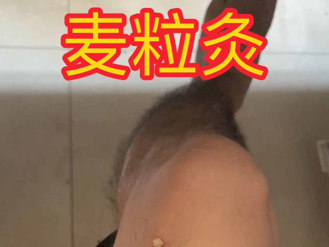 中医针灸之艾灸麦粒灸直接灸