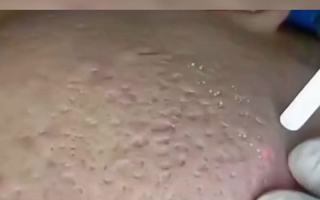 如果是痤疮瘢痕遗留的痘坑,时间久了以后,皮肤不一定能自行修复好!...