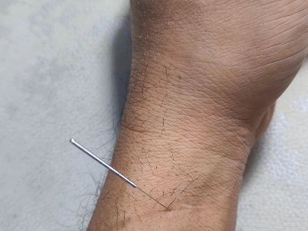 列缺经渠太渊下针实操视频笔记。