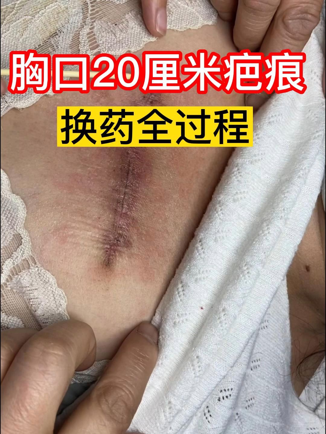 女子胸口20厘米伤疤换药全过程