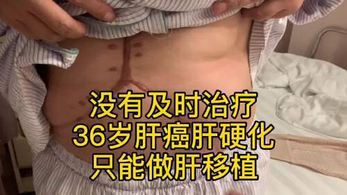 太可惜!肝炎没事及时抗病毒治疗,最后变成肝硬化肝癌,只能做肝移植手术