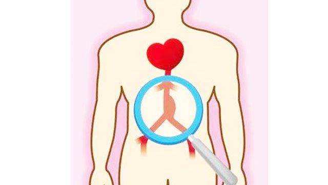 什么是腹主动脉粥样硬化?哪种情形下需手术干预?