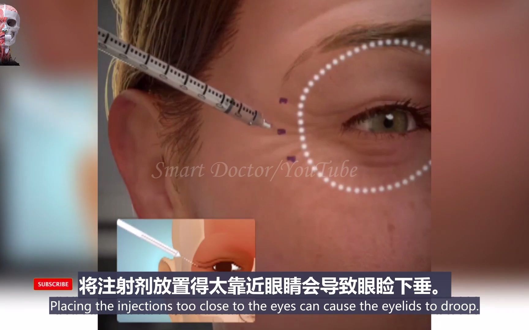 注射肉毒杆菌前后的脸部ߒ�注射是如何进行的