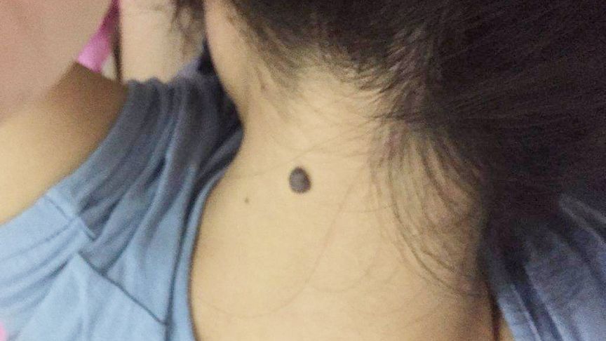 什么是痣,痣怎么去除?