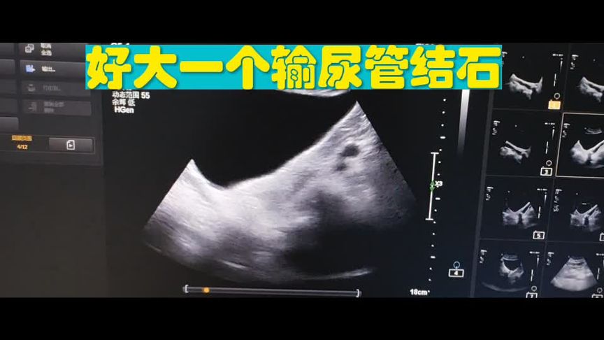 输尿管下段结石 输尿管下段结石。#医学科普 #超声影像 #超声学习