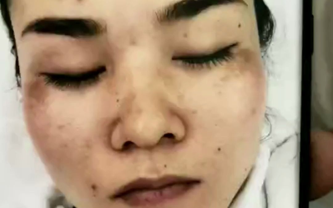 ... 但也是祛斑的黄金季节, 皮肤细胞随之苏醒, 肌体新陈代谢加快, 皮肤...