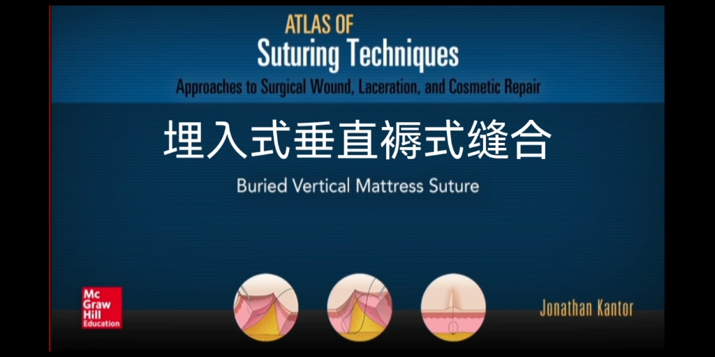深部组织的缝合技术:筋膜与真皮——4.3埋入式垂直褥式缝合