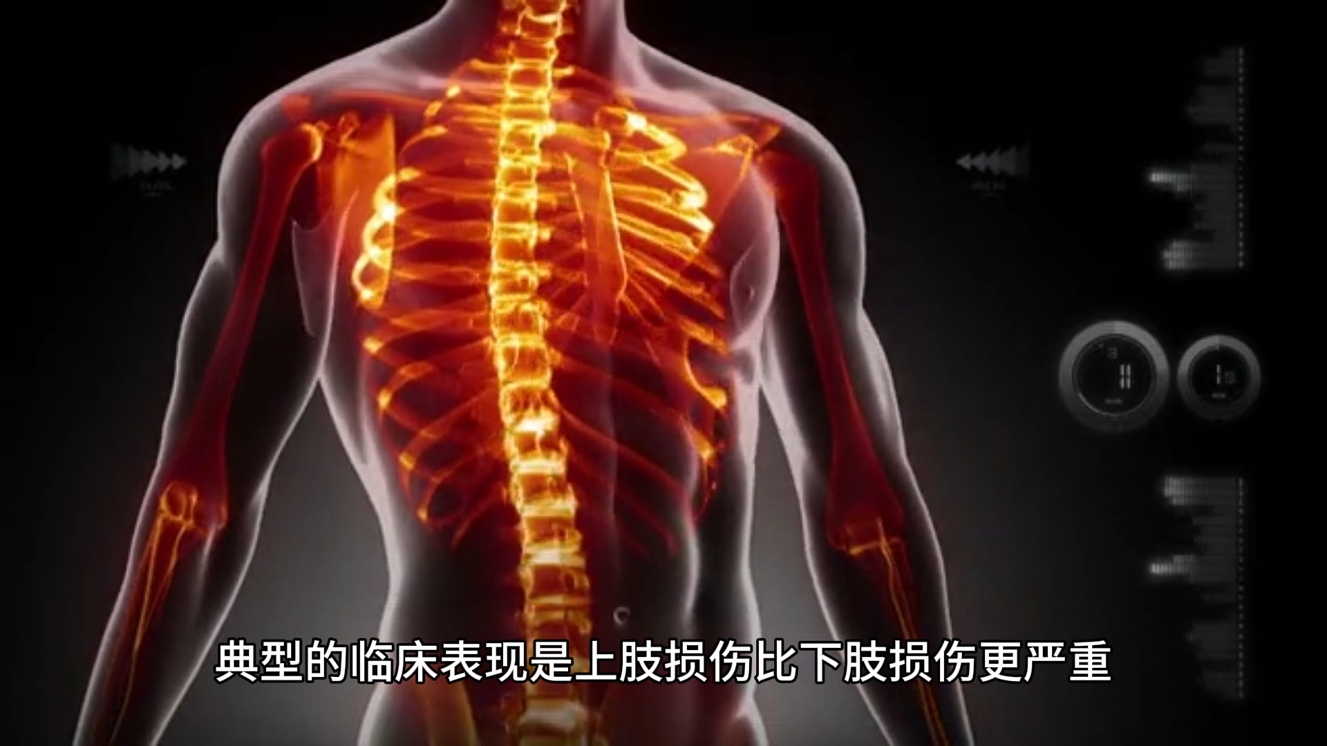 根据脊髓损伤的位置,不完全性脊髓损伤通常根据位置分类。例如,脊髓...