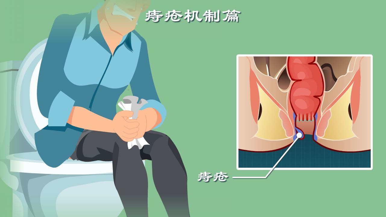 痔疮2:最重口味的痔疮科普