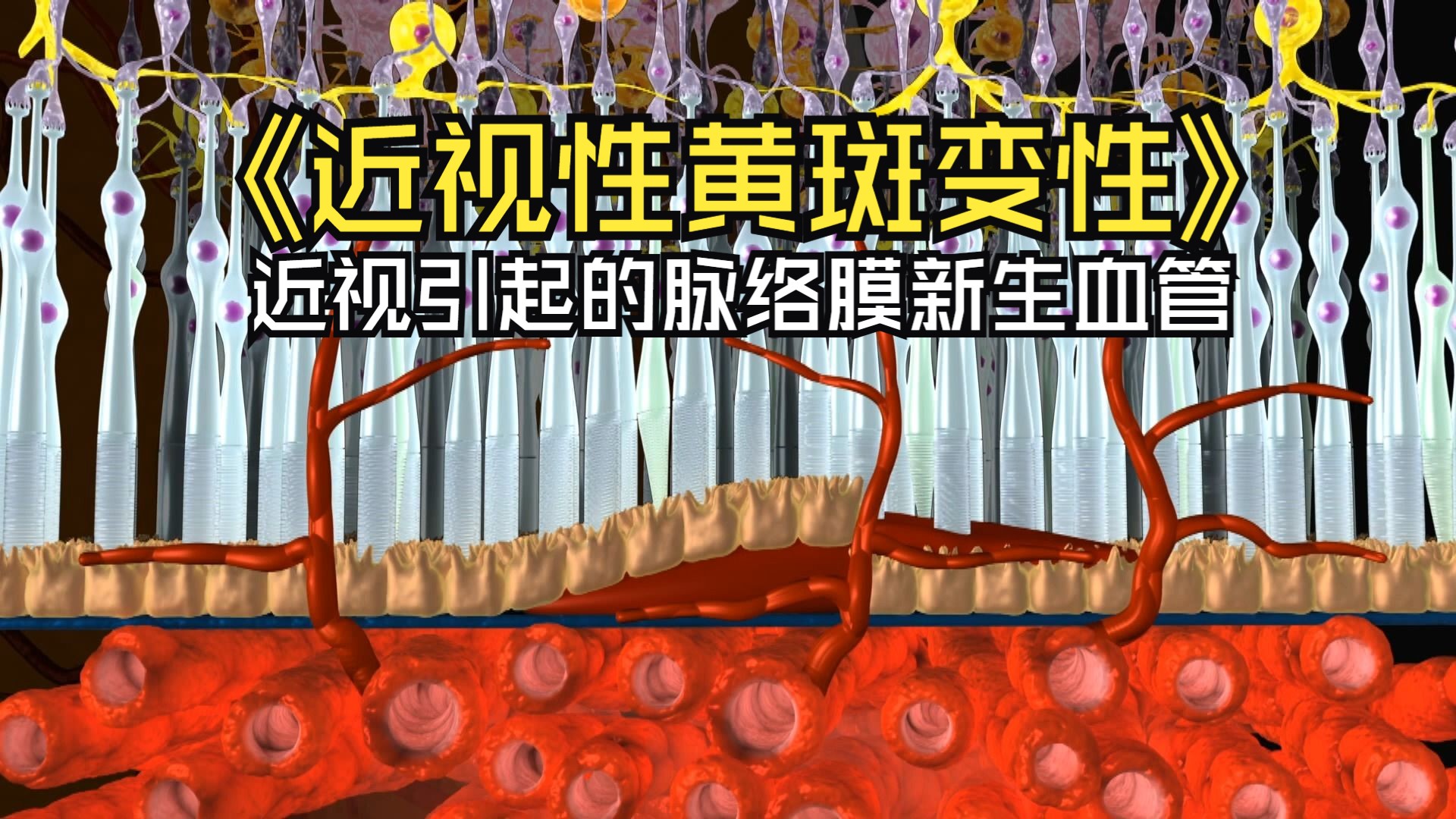 【3D动画】【近视性黄斑变性、脉络膜新生血管】Myopic CNV