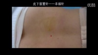 无痛皮下留置针疗法治疗局部痛点——腰部痛点的局部疏拨治疗