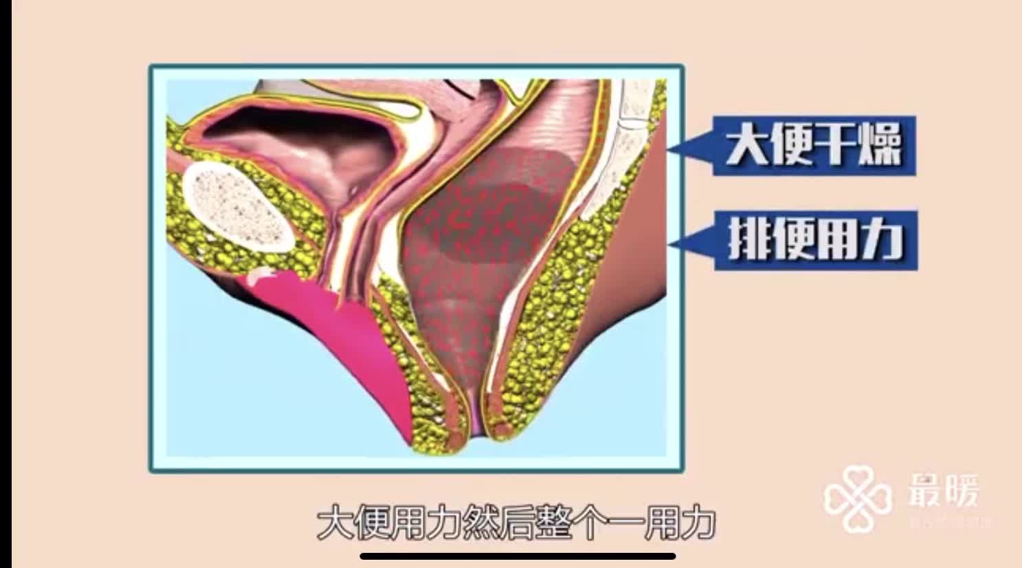 为什么便秘患者会便血?#便秘#