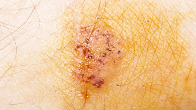 皮肤瘙痒怎么解脱?用它轻轻一搓,不再受皮肤癣的折磨