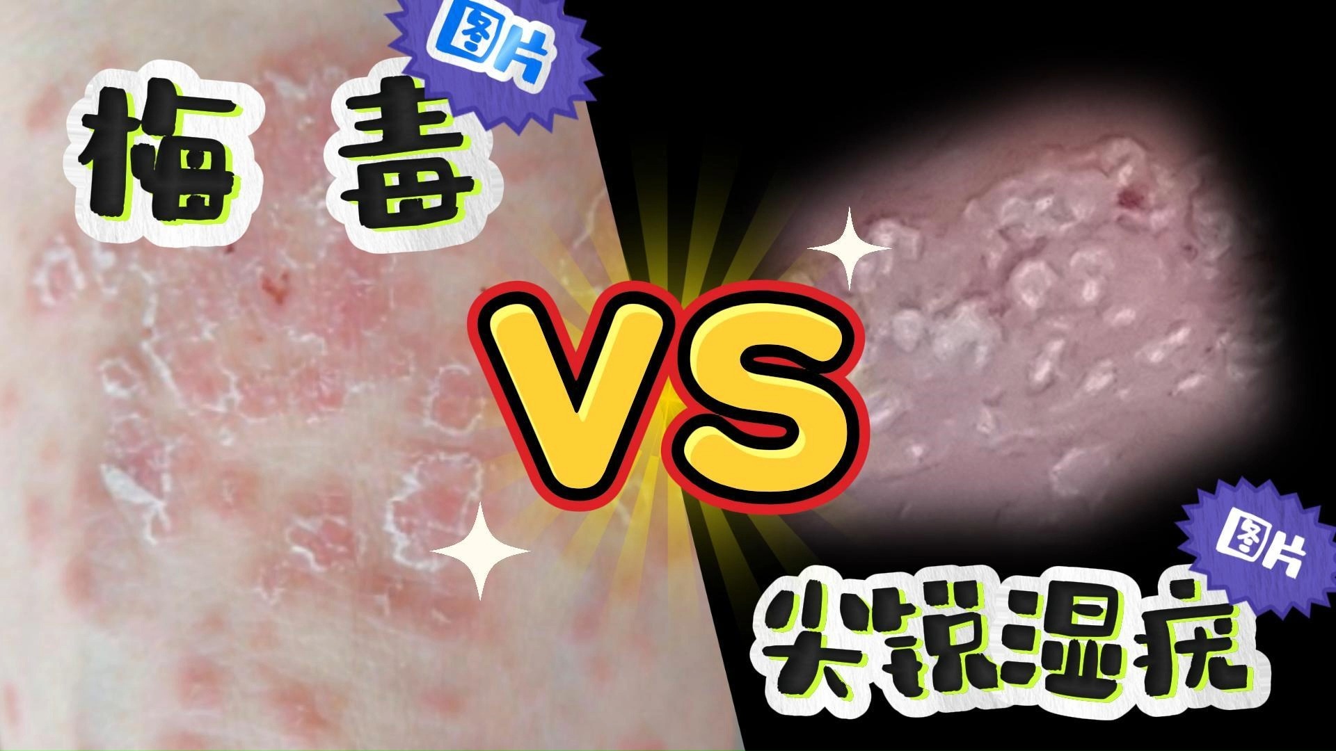 【尖锐湿疣】第十七期 | 尖锐湿疣VS梅毒 | hpv图片