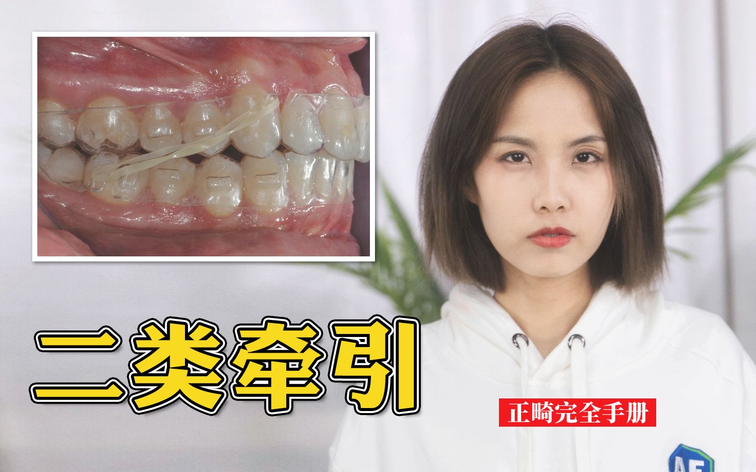 我的正畸医生竟然给我挂二类牵引?狗头.jpg