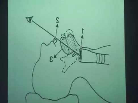 第三讲-气管插管