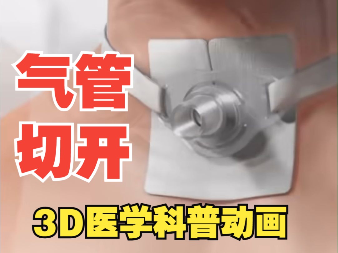 生命管道!气管切开日常护理 3D医学科普动画中文版