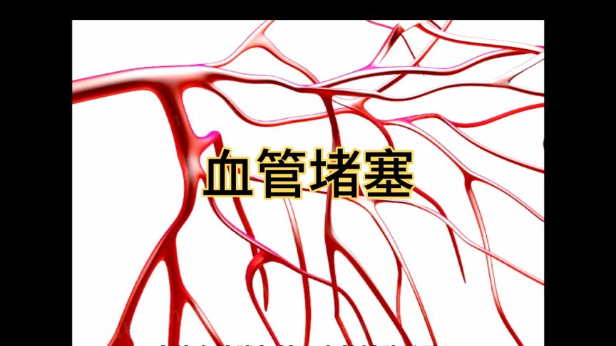 你的血管堵塞的全过程是这样的!每个人都应该认真看看!