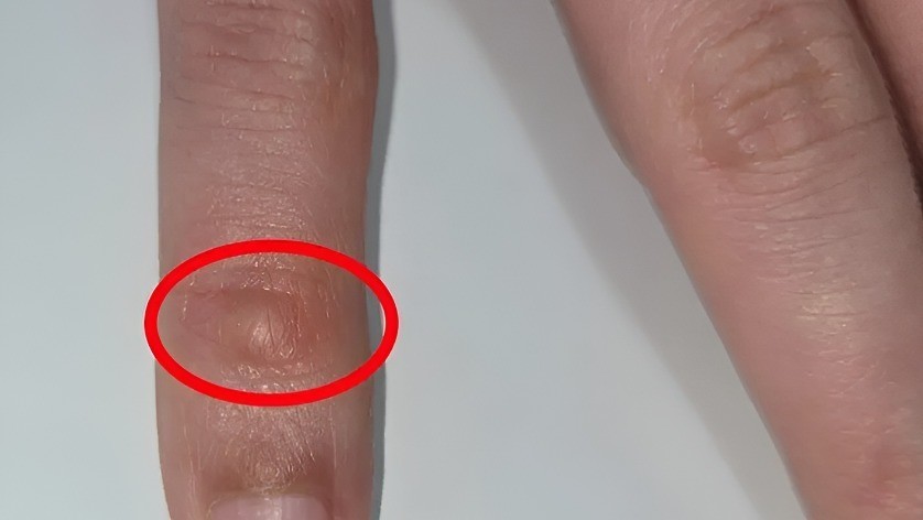 你可能正在做!男子小拇指长包怀疑感染HPV,没想到竟跟手机有关