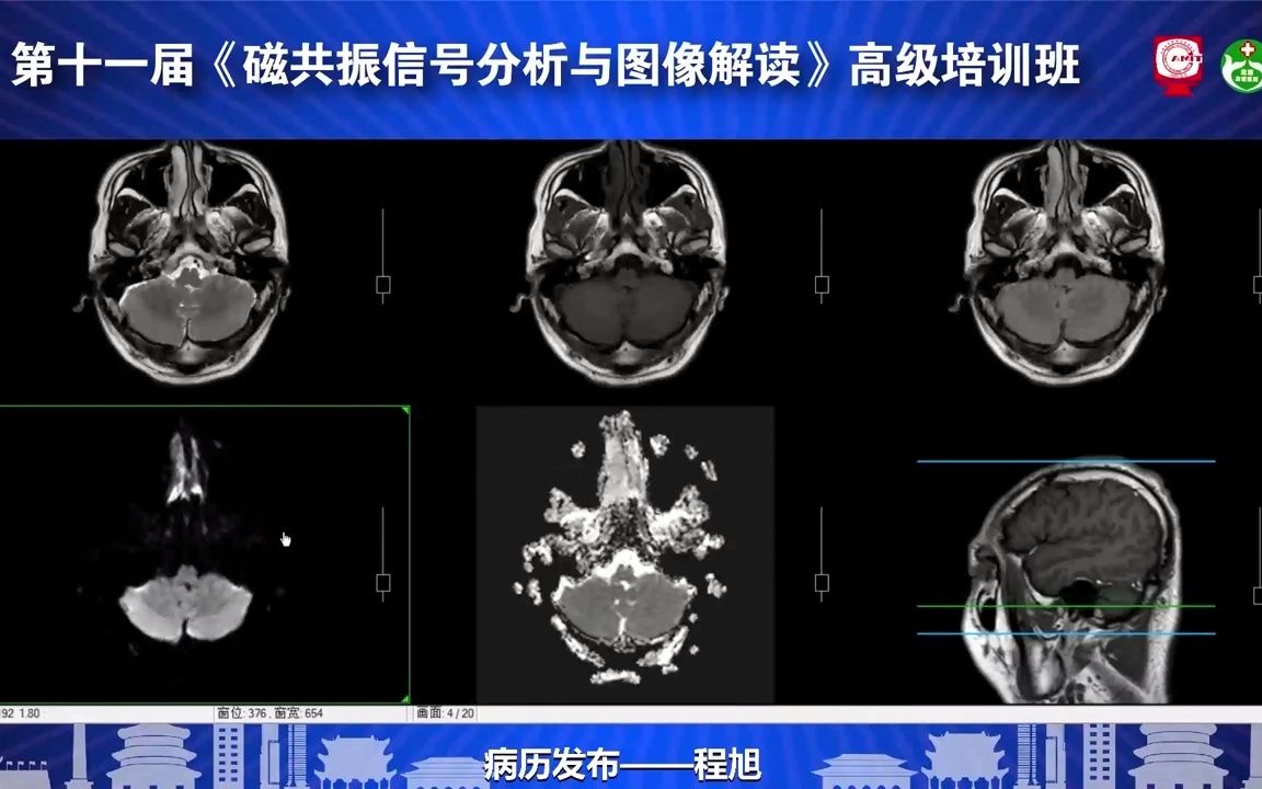中枢系统病例讨论5