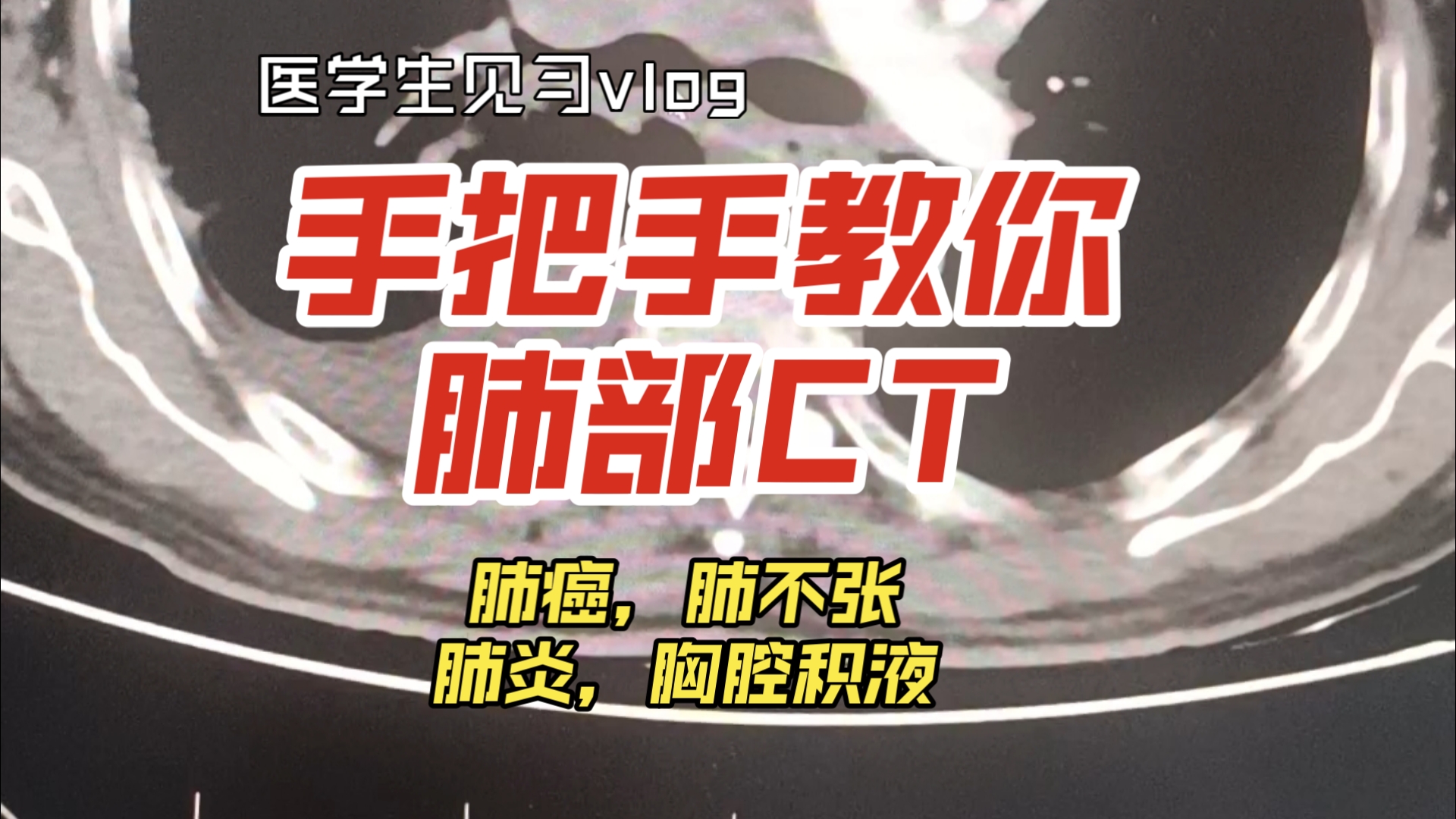 手把手教你:4步看懂肺部CT(中央型肺癌,阻塞性肺炎,肺不张,胸腔积液,...