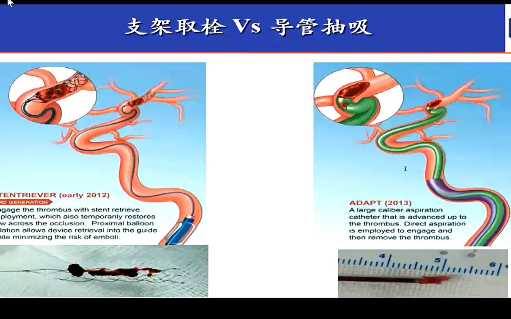 抽吸取栓ADAPT技术的操作和导管选择 | 杨鹏飞