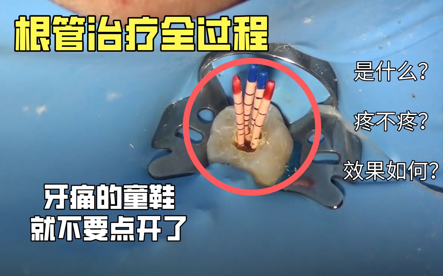 【实拍】根管治疗全过程,牙痛牙疼的童鞋就不要点开了!
