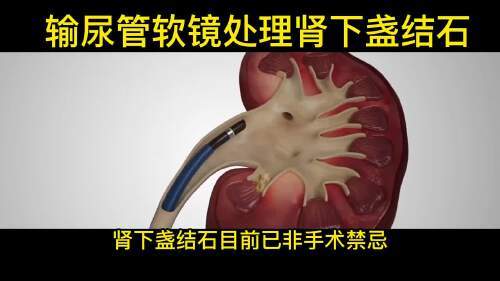 输尿管软镜处理肾下盏结石!