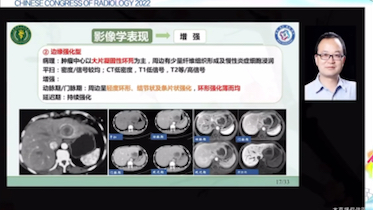 (自学)肝炎性肌纤维母细胞瘤影像诊断