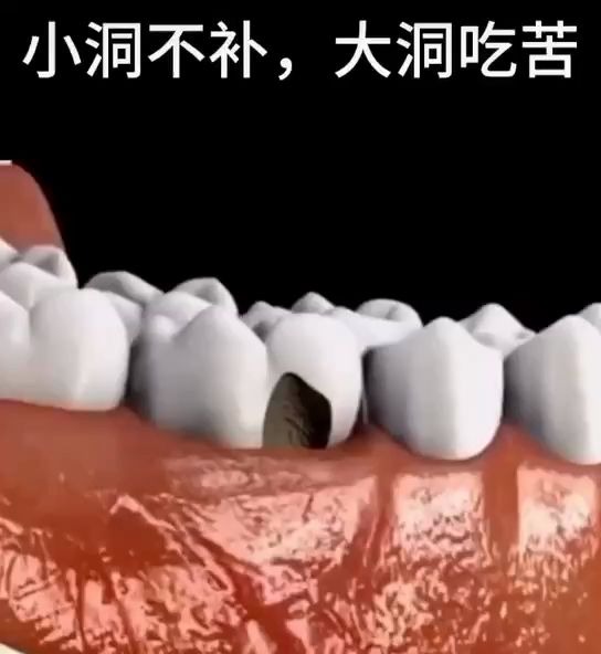 【深圳补牙】小洞不补大洞吃苦,蛀牙一定要补牙吗?深圳补牙多少钱?