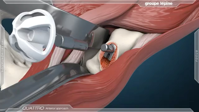 3D动画髋关节置换术