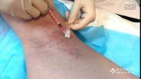 肉毒毒素注射技巧 腋臭治疗 | 北京协和医院