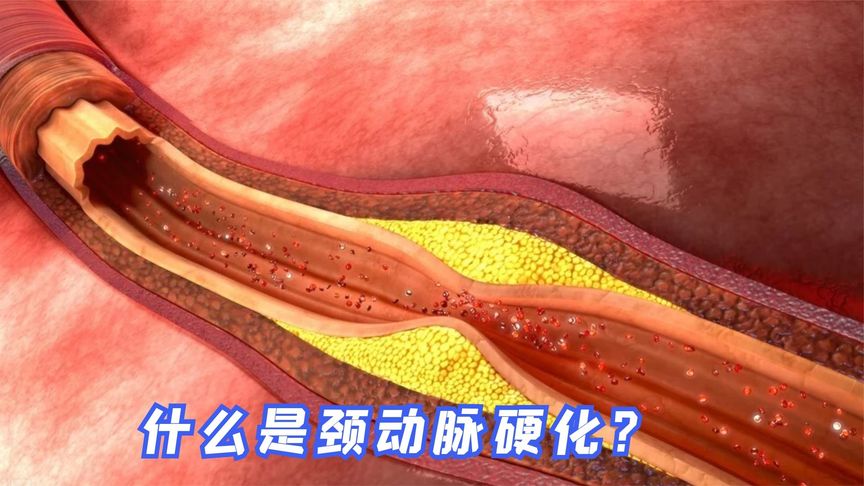 什么是颈动脉硬化?医生坦言:是引起头晕、脑梗塞的“元凶”