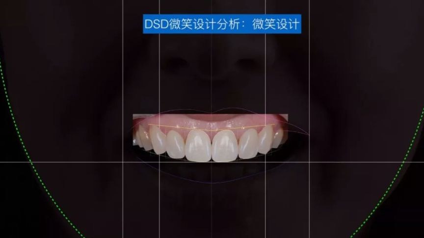DSD微笑设计分析:微笑设计
