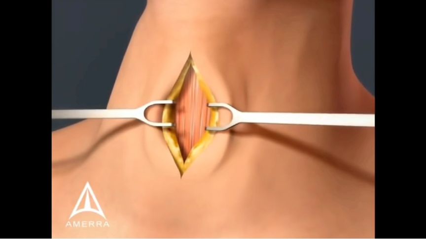 急救时,器官切开插管手术过程,3D演示。