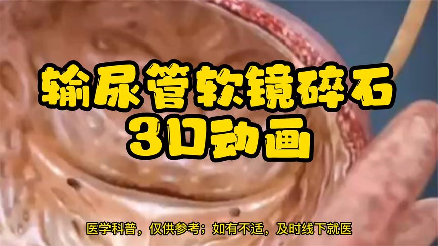 3D动画输尿管软镜碎石,看完一定要好好爱惜自己的身体