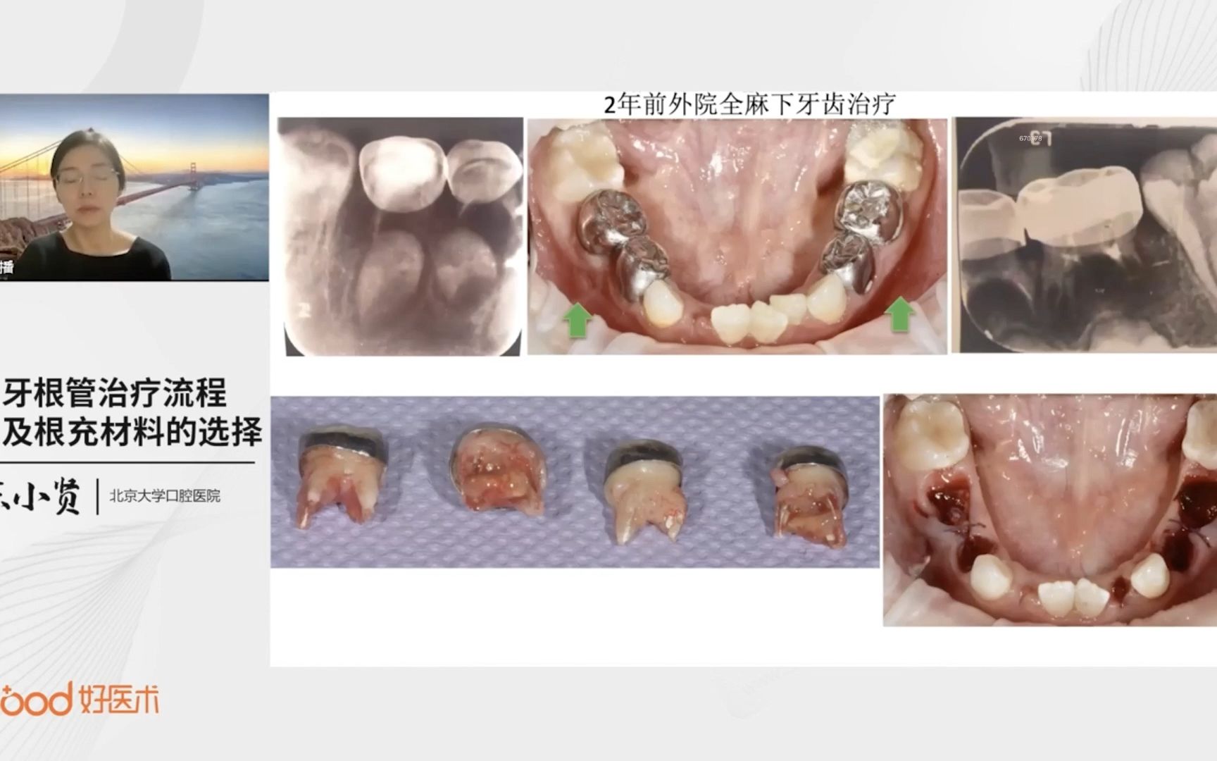 乳牙根管治疗流程以及根充材料的选择