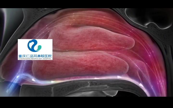 重庆仁品鼻窦炎手术治疗过程3d动画