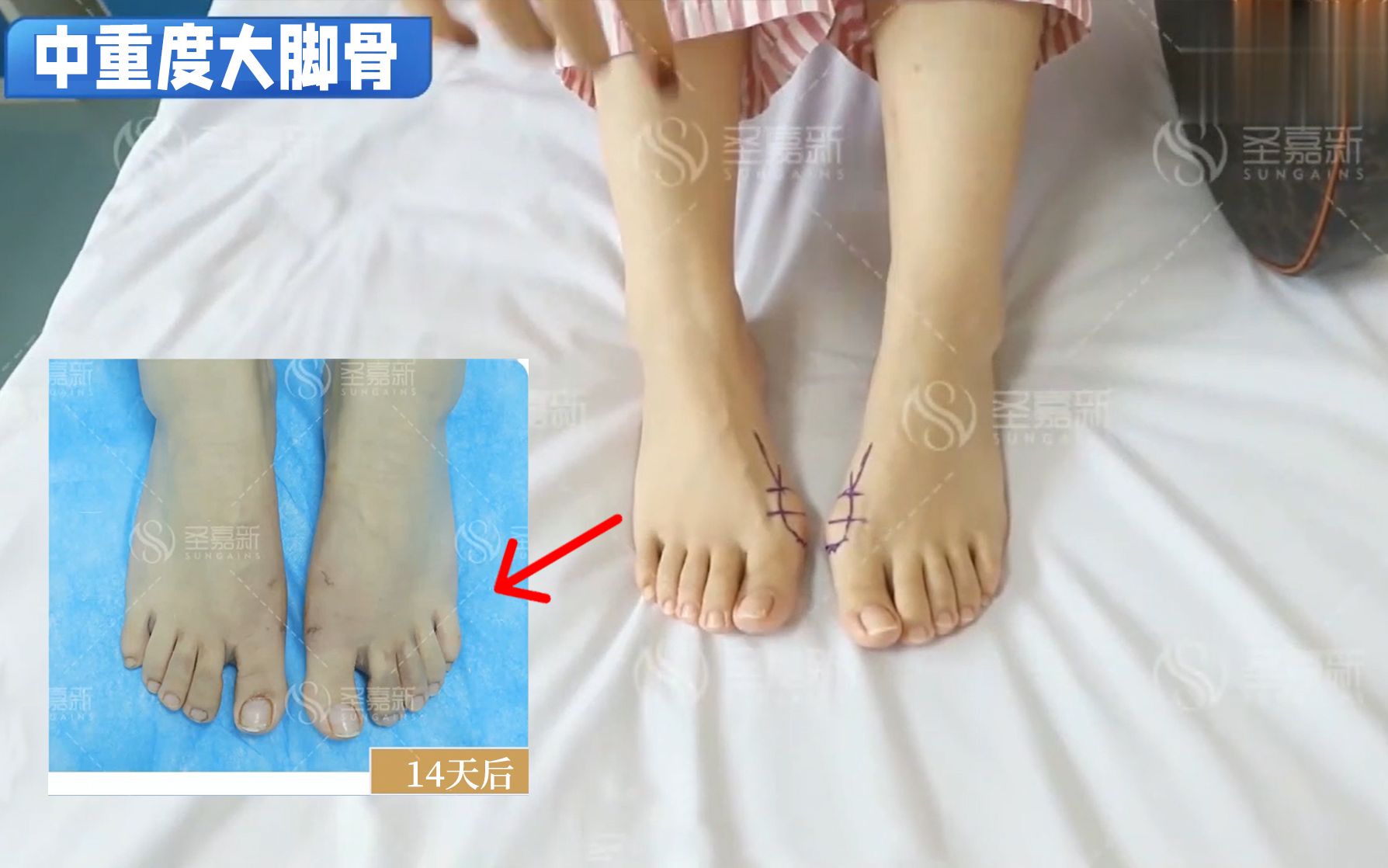 北京苏敬达医生:足弓低平也和拇外翻有关?走路疼?手术治疗14天后,...