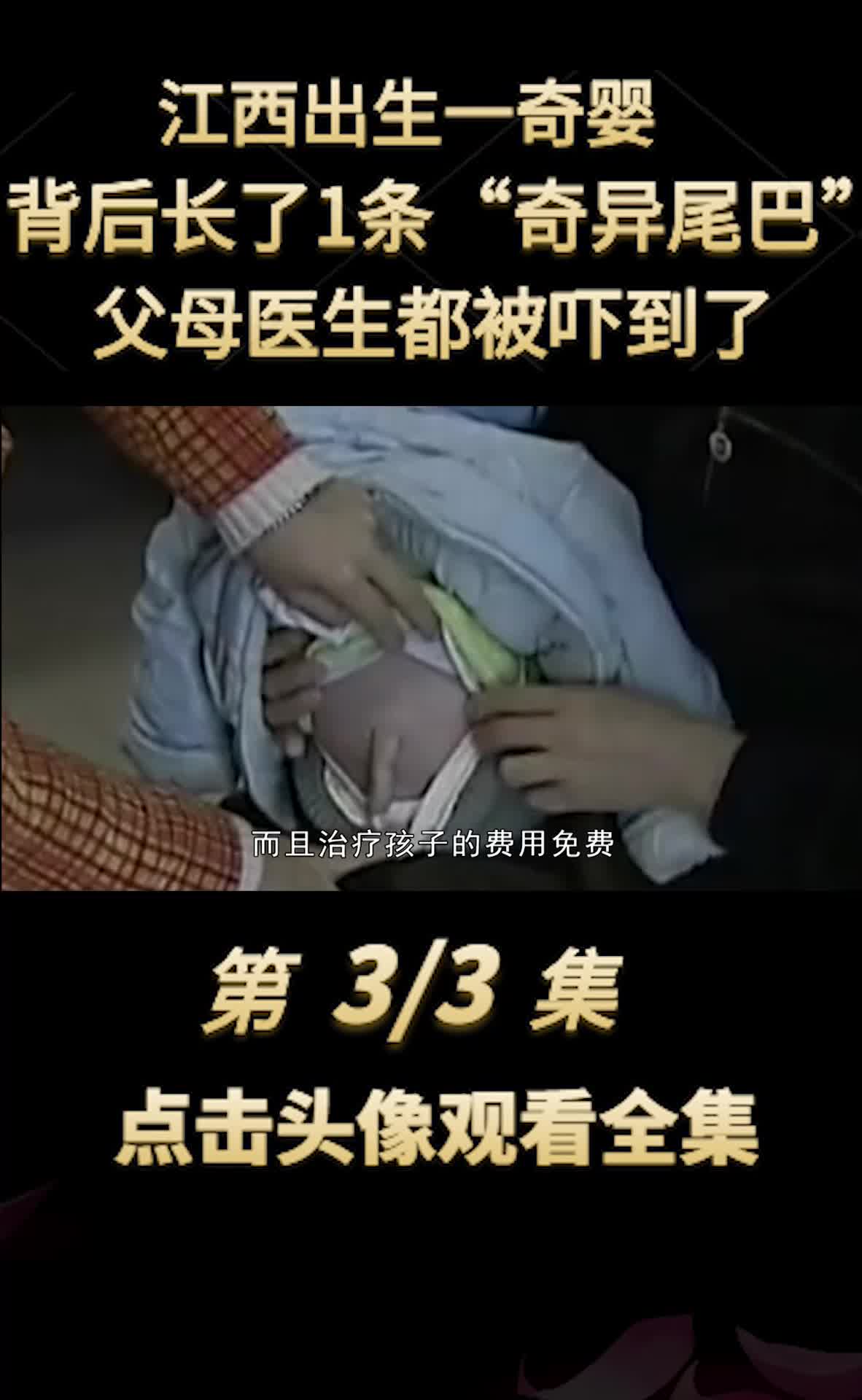 江西出生一奇婴,背后长了1条“奇异尾巴”,父母医生都被吓到了#奇闻...