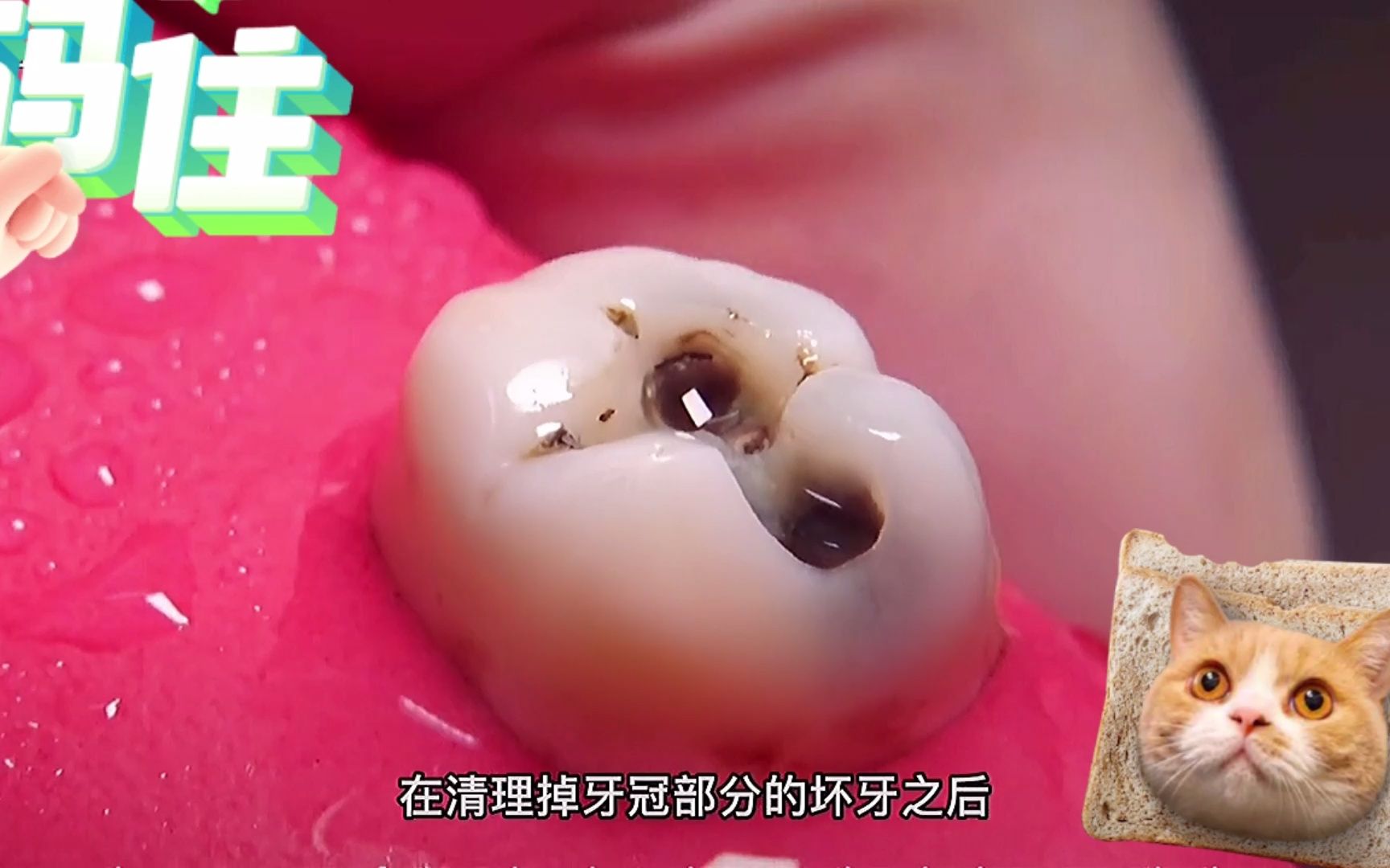 蛀牙是怎么修复的